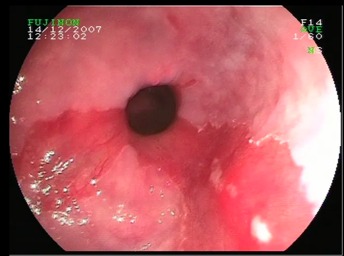 Avances en la vigilancia en el esófago de Barrett - Consulta de Aparato ...